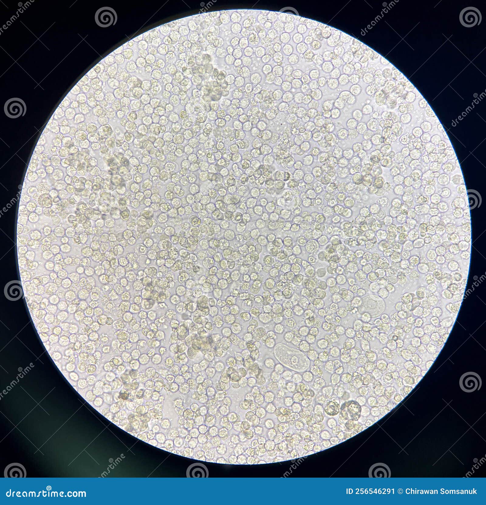 Protein And White Blood Cells In Urine But No Infection at Neal Marquez ...