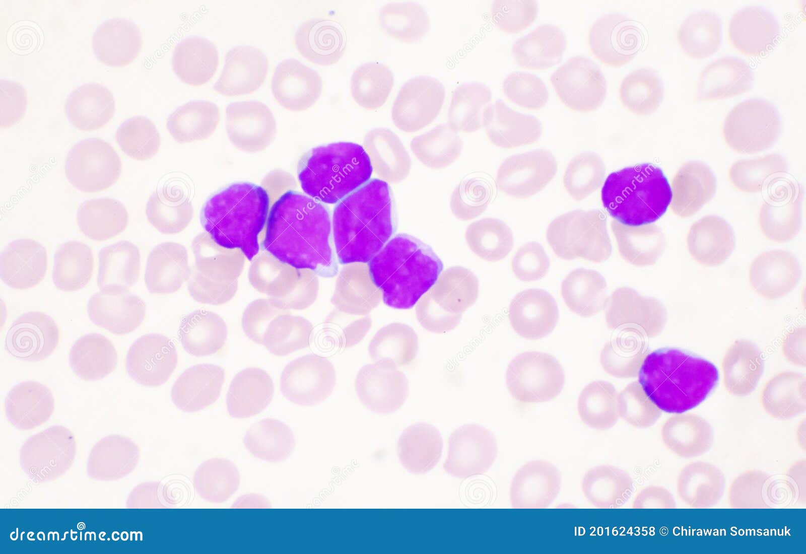 Moderate Blast Cell of White Blood Cells in Blood Smear Stock Photo ...