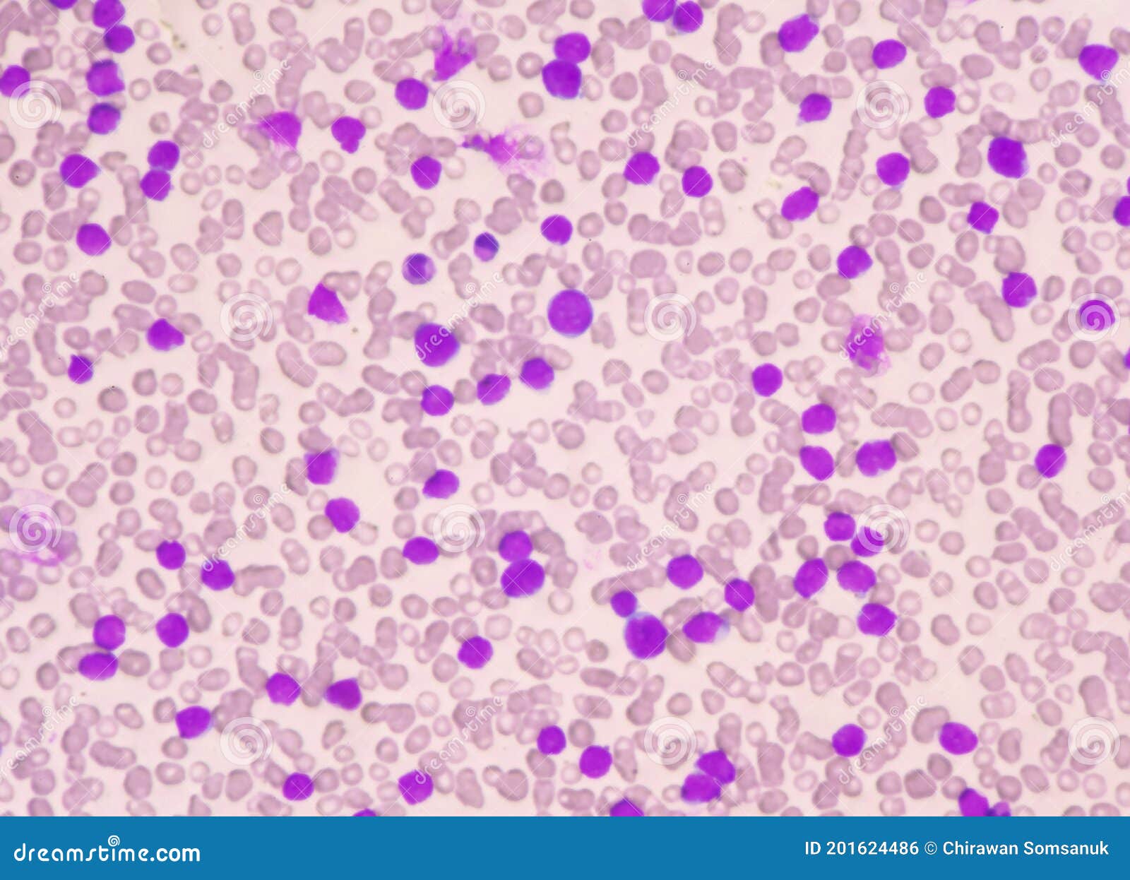 Moderate Blast Cell of White Blood Cells in Blood Smear Stock Photo ...