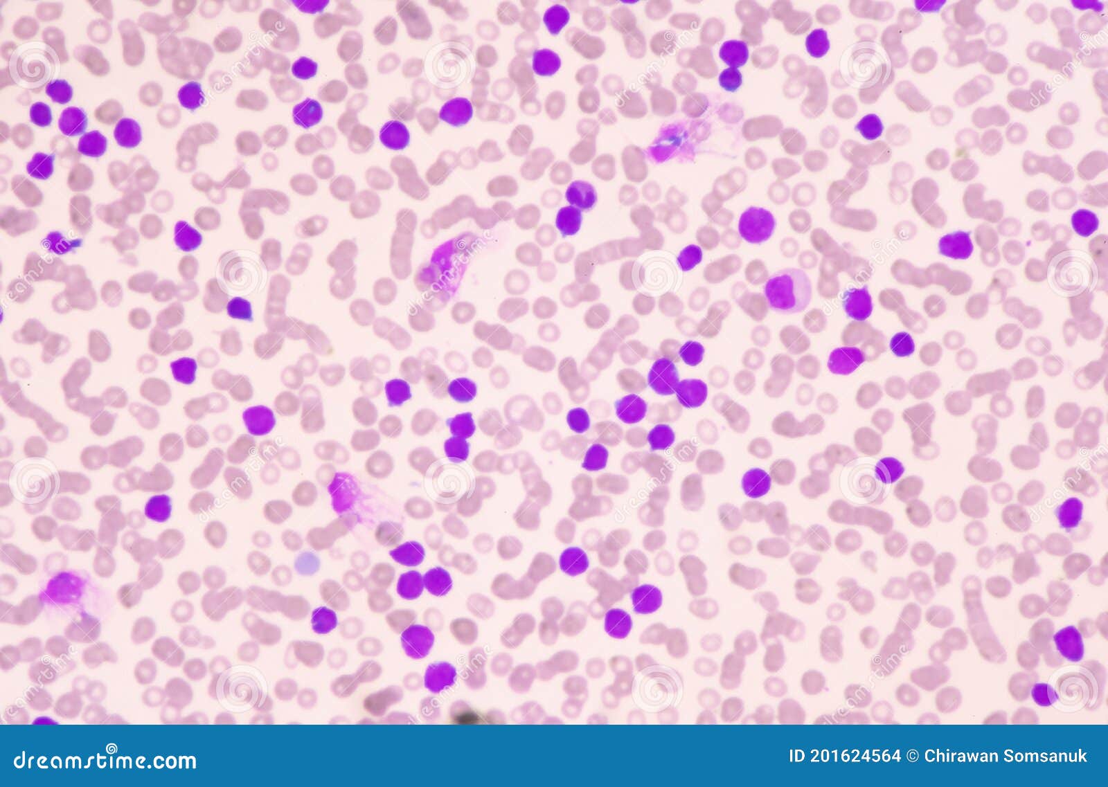 Moderate Blast Cell Of White Blood Cells In Blood Smear Royalty-Free ...