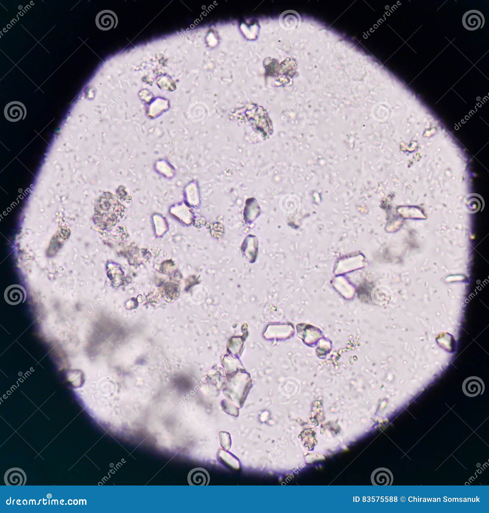 Moderate Bacteria And White Blood Cells In Patien Bacteria Urinary ...