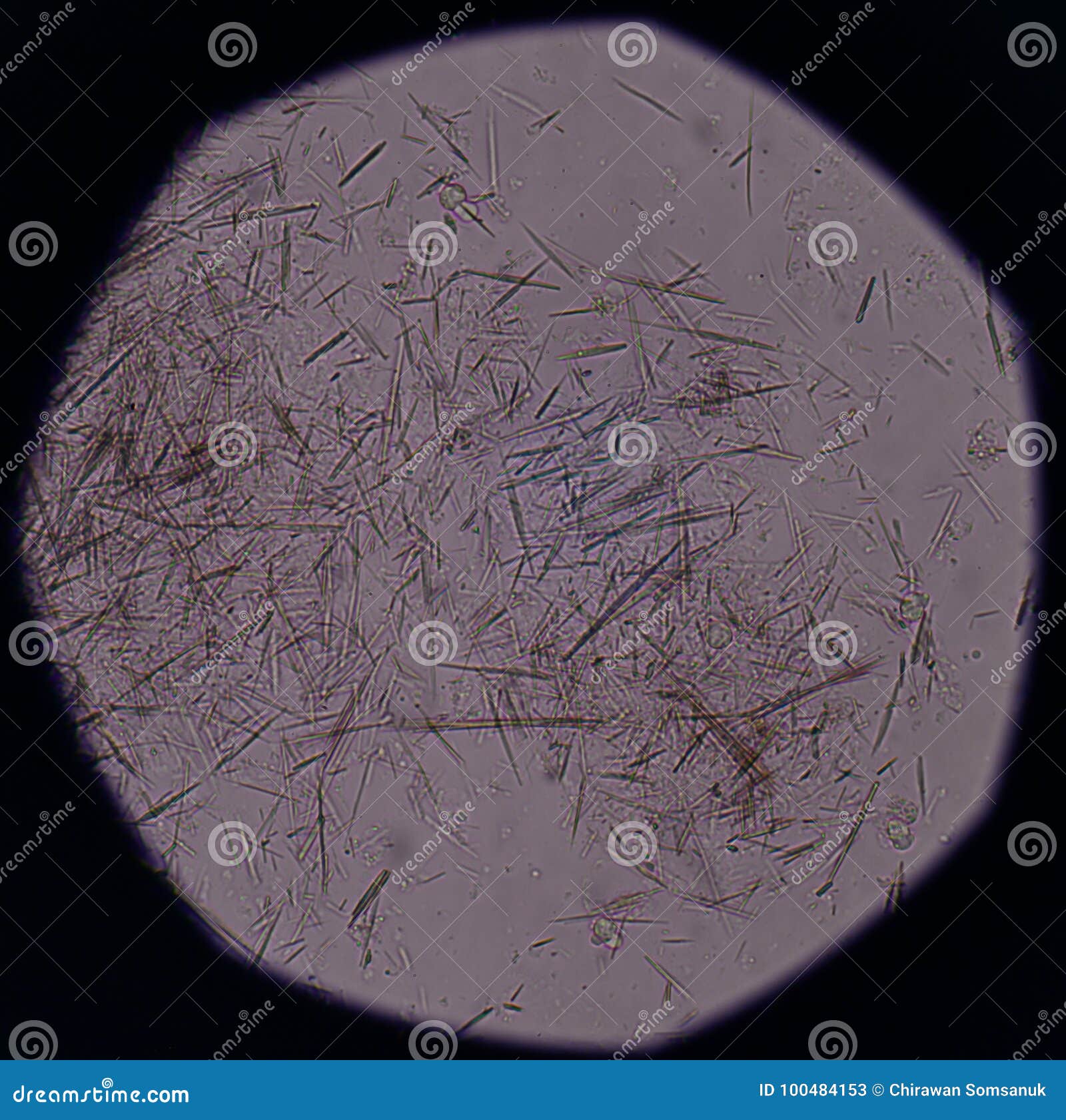 Moderate Uric Acid Crystal Needle Shape. Stock Image - Image of ...