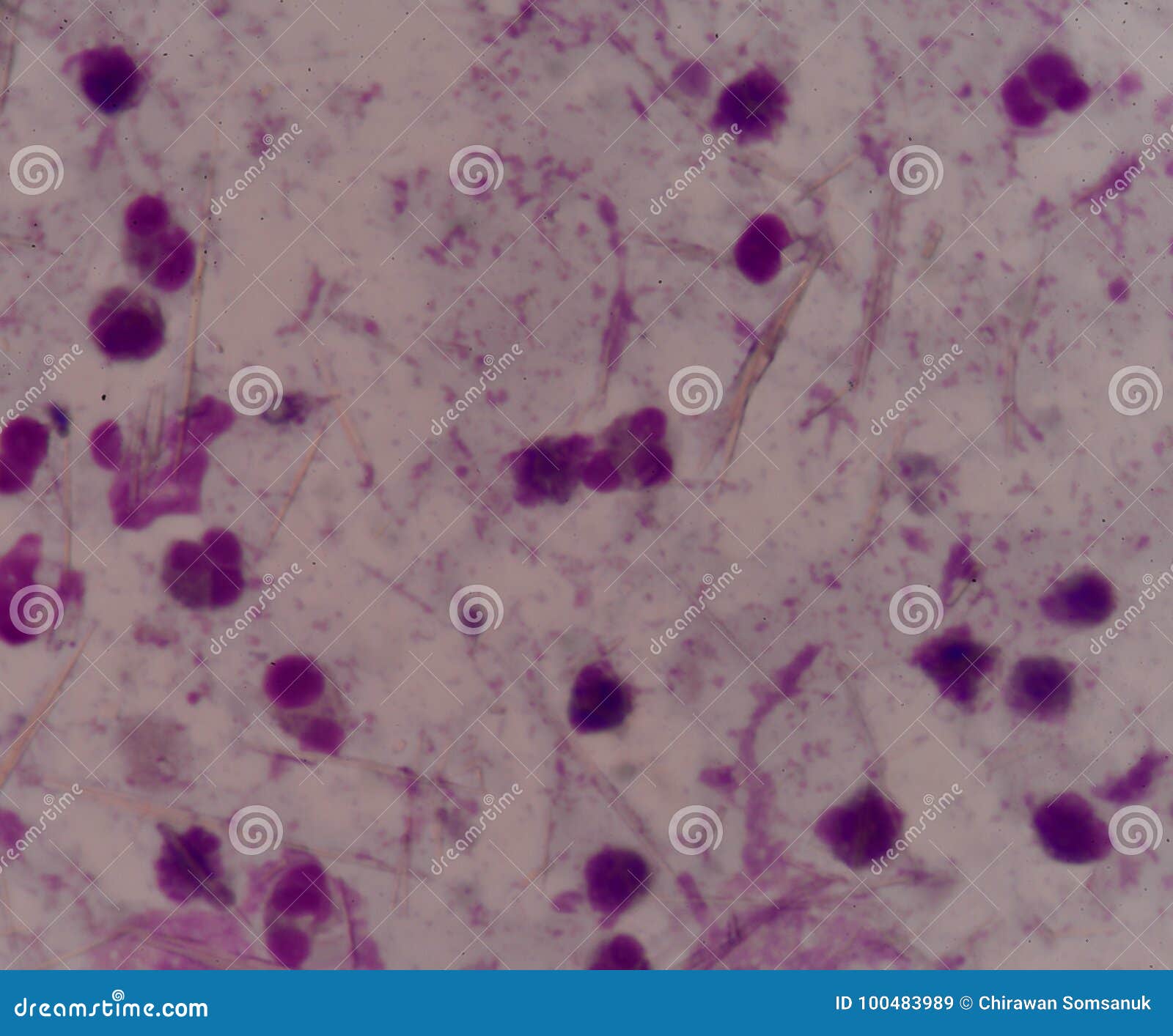 White Blood Cells with Uric Acid Crystal Needle Shape. Stock Image ...