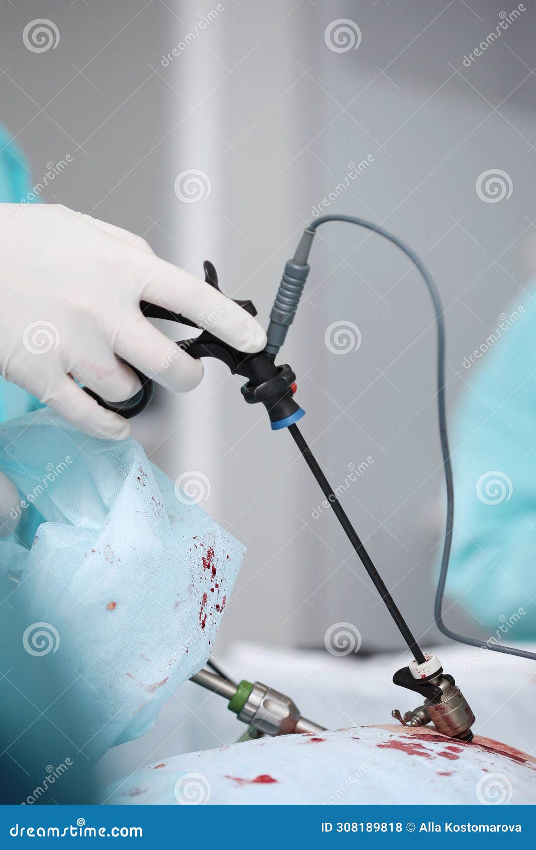 Modern Abdominal Surgery. Laparoscopy in Surgery. Surgical Intervention ...