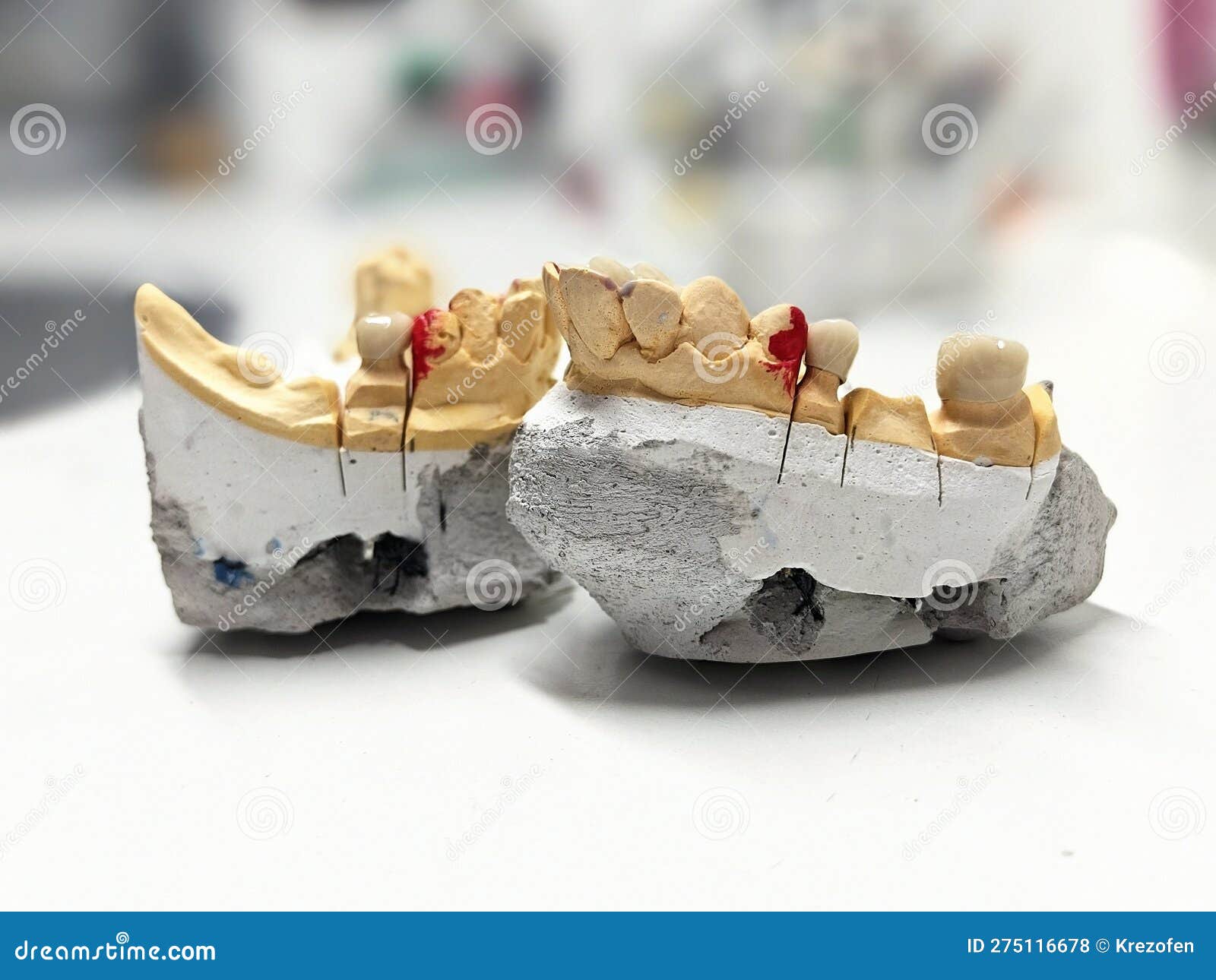 Modern Ceramic-metal Dental Bridge for Restoring Dentition Stock Photo ...