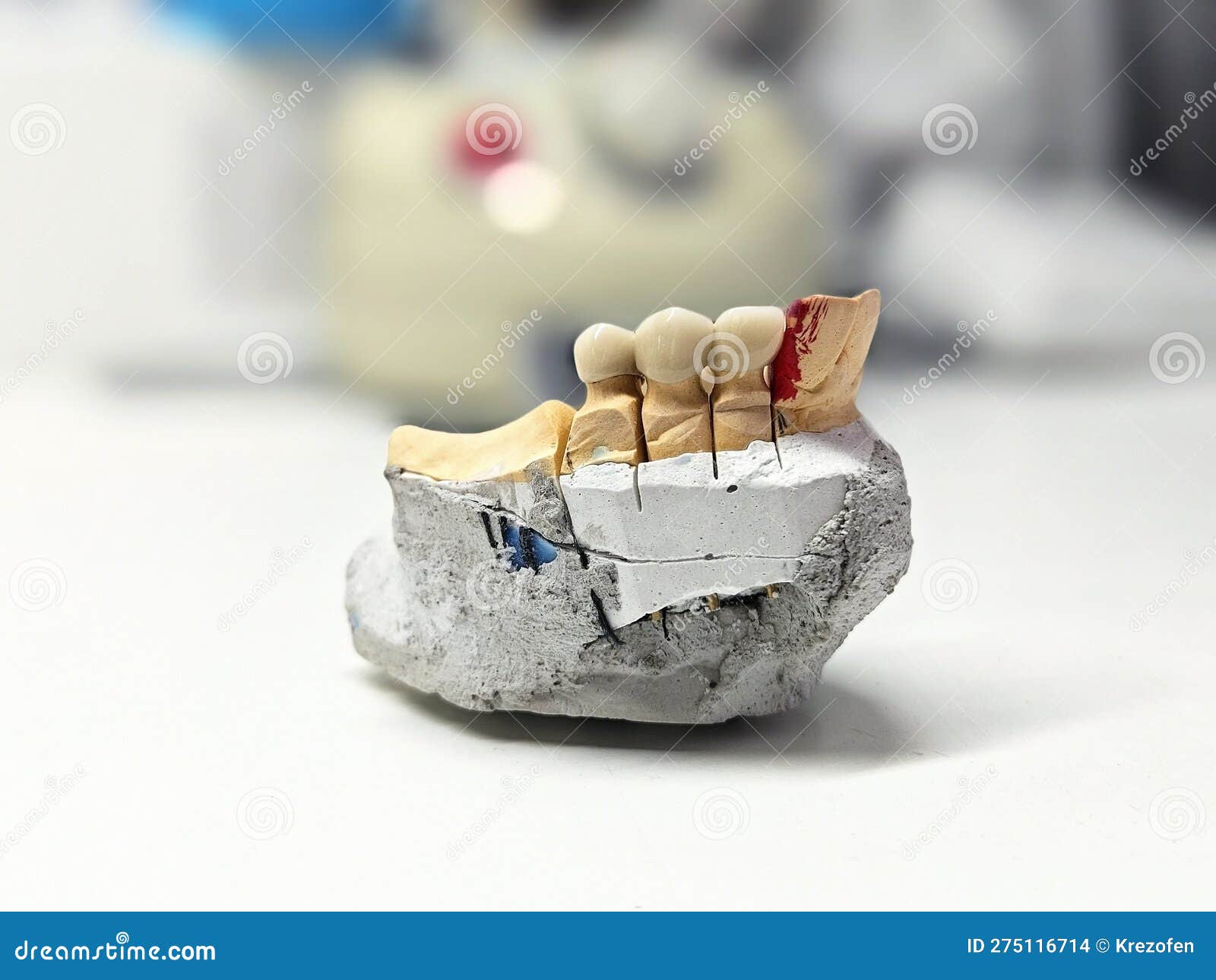 Modern Ceramic-metal Dental Bridge for Restoring Dentition Stock Photo ...