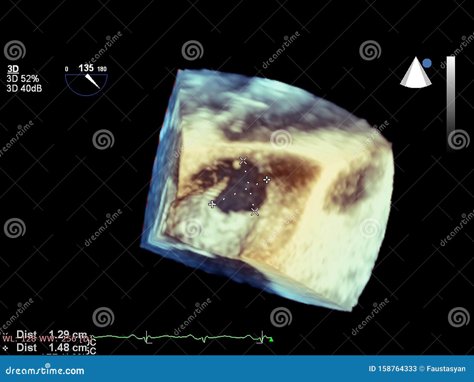 Modern 3D echocardiography stock image. Image of embryo - 158764333
