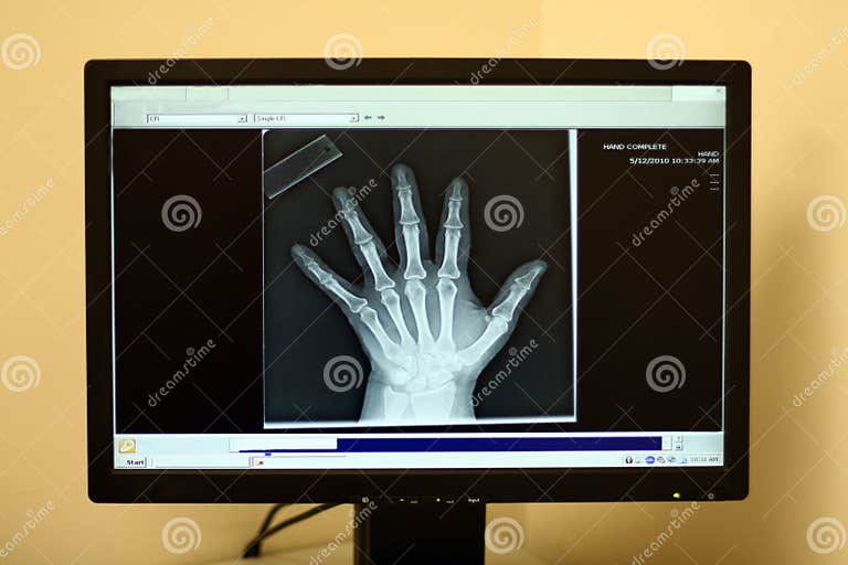 Modern X-ray Display of Human Hand Stock Image - Image of medical ...