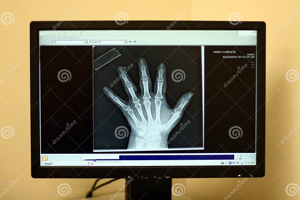 Modern X-ray Display of Human Hand Stock Image - Image of medical ...