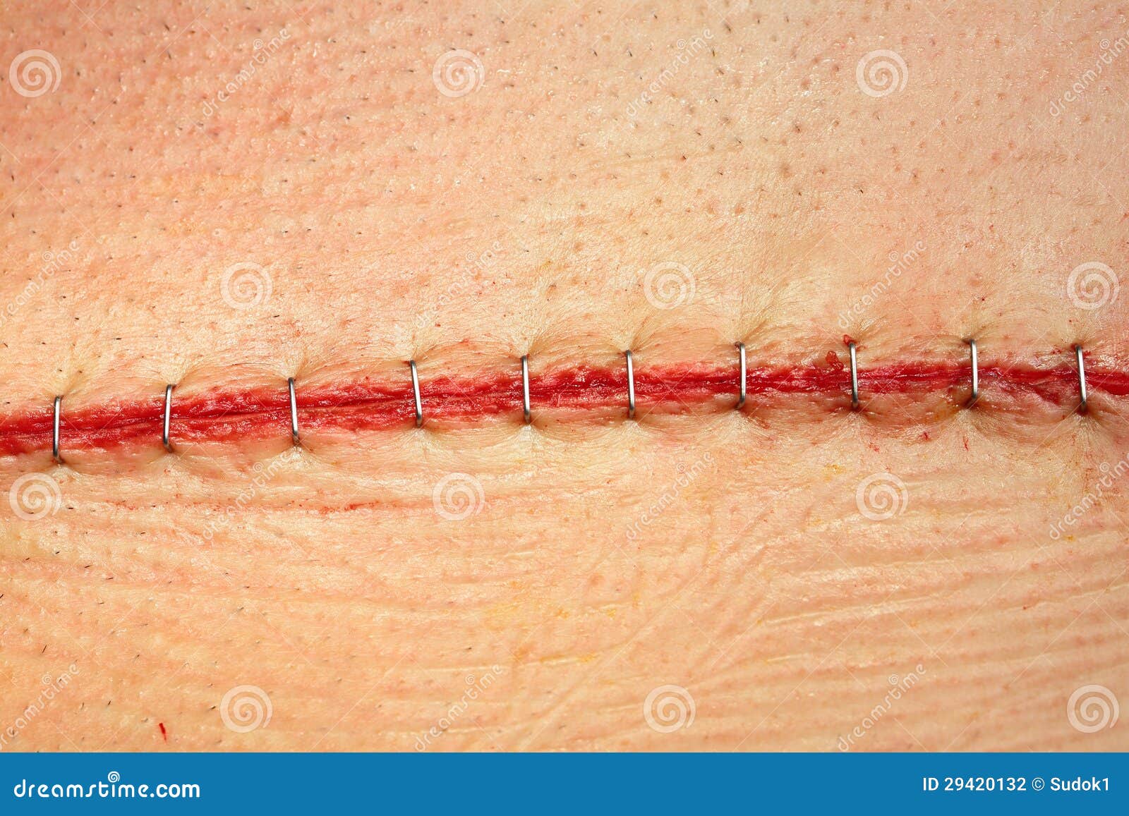 Modern surgical suture. stock photo. Image of clamp, doctor - 29420132