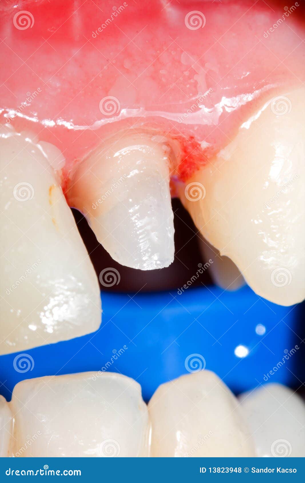 Moignon De Dent Pour La Tête Photo stock - Image du dentaire ...