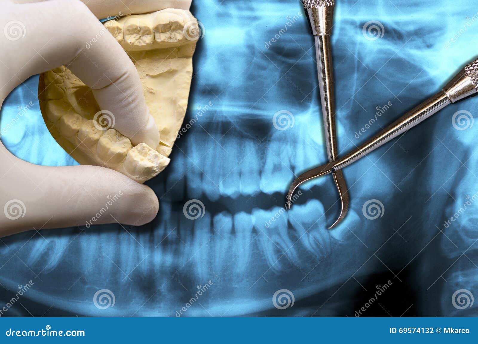 Molar Teeth Extraction Over Dental Scan Stock Photo - Image of oral ...