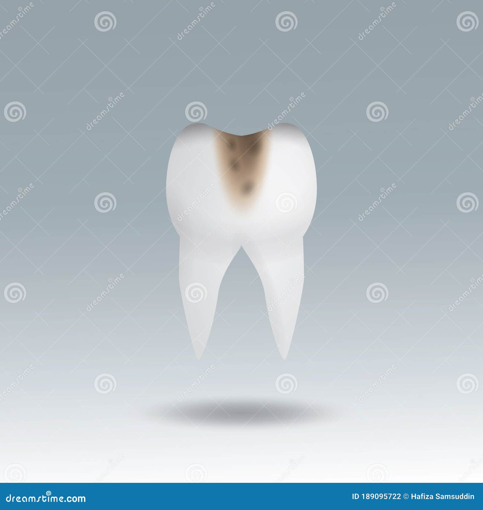 Molar Tooth Cavity. Vector Illustration Decorative Design Stock Vector ...