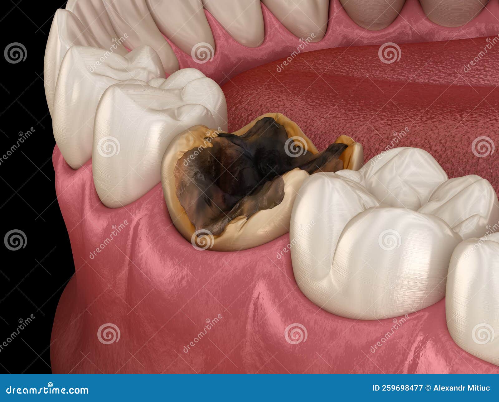 Molar Tooth Damaged by Caries. Medically Accurate Tooth 3D Illustration ...