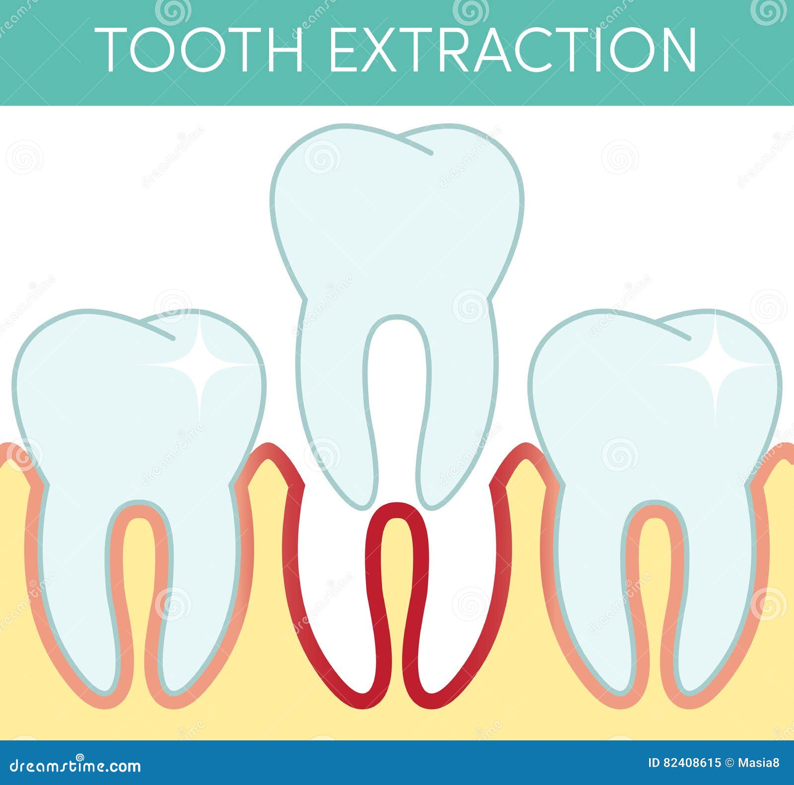 Molar tooth removal stock illustration. Illustration of health - 82408615