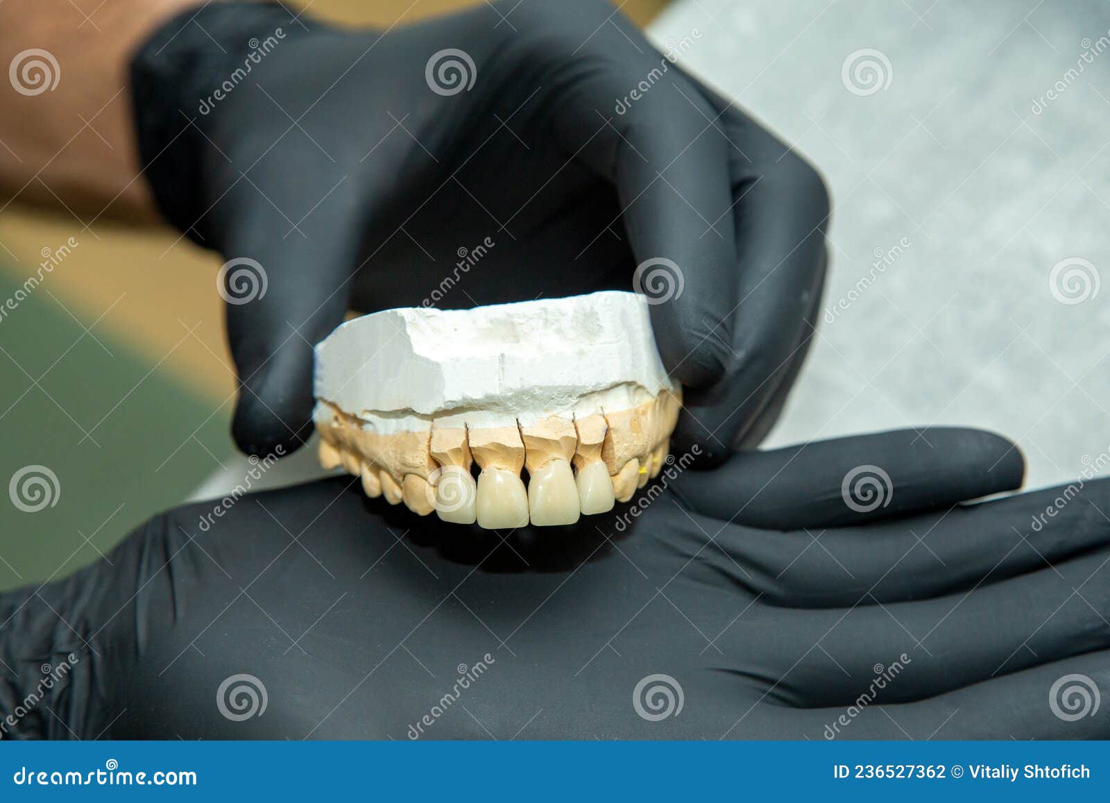 Mold of Teeth at the Dentist in His Hands Stock Photo - Image of ...