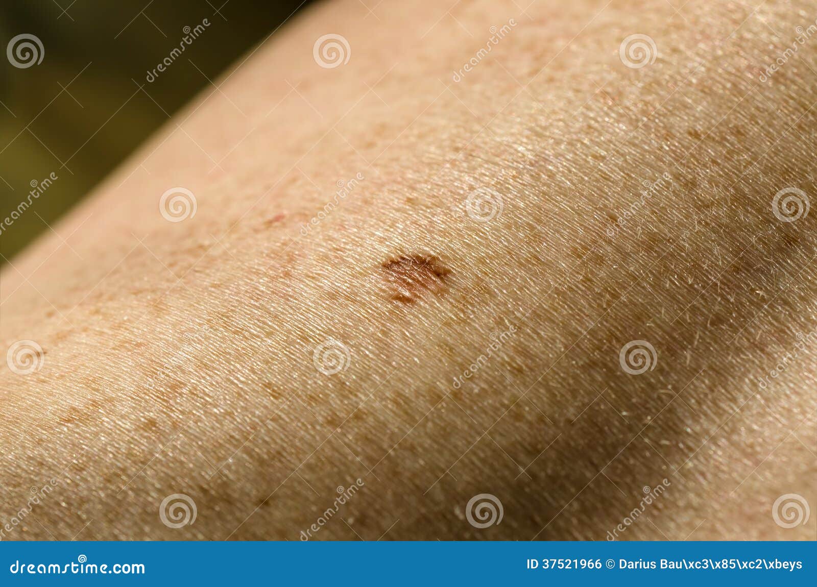 Close-up Of Molluscum Contagiosum Also Called Water Wart. Viral ...