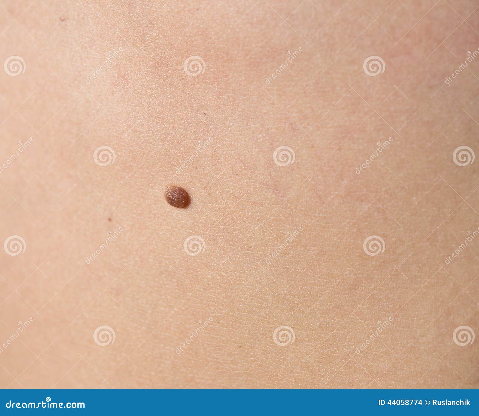 Mole stock photo. Image of patch, skin, birthmark, dermatology - 44058774