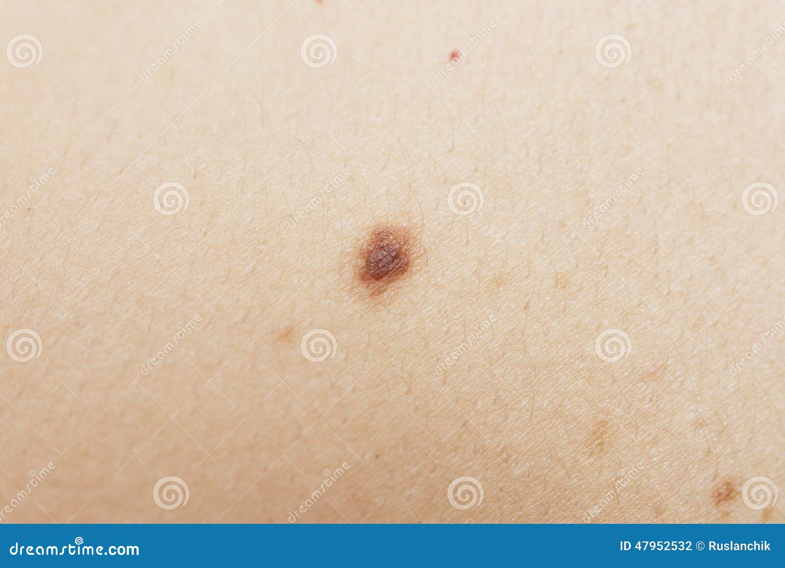 Mole stock photo. Image of large, dermatology, health - 47952532