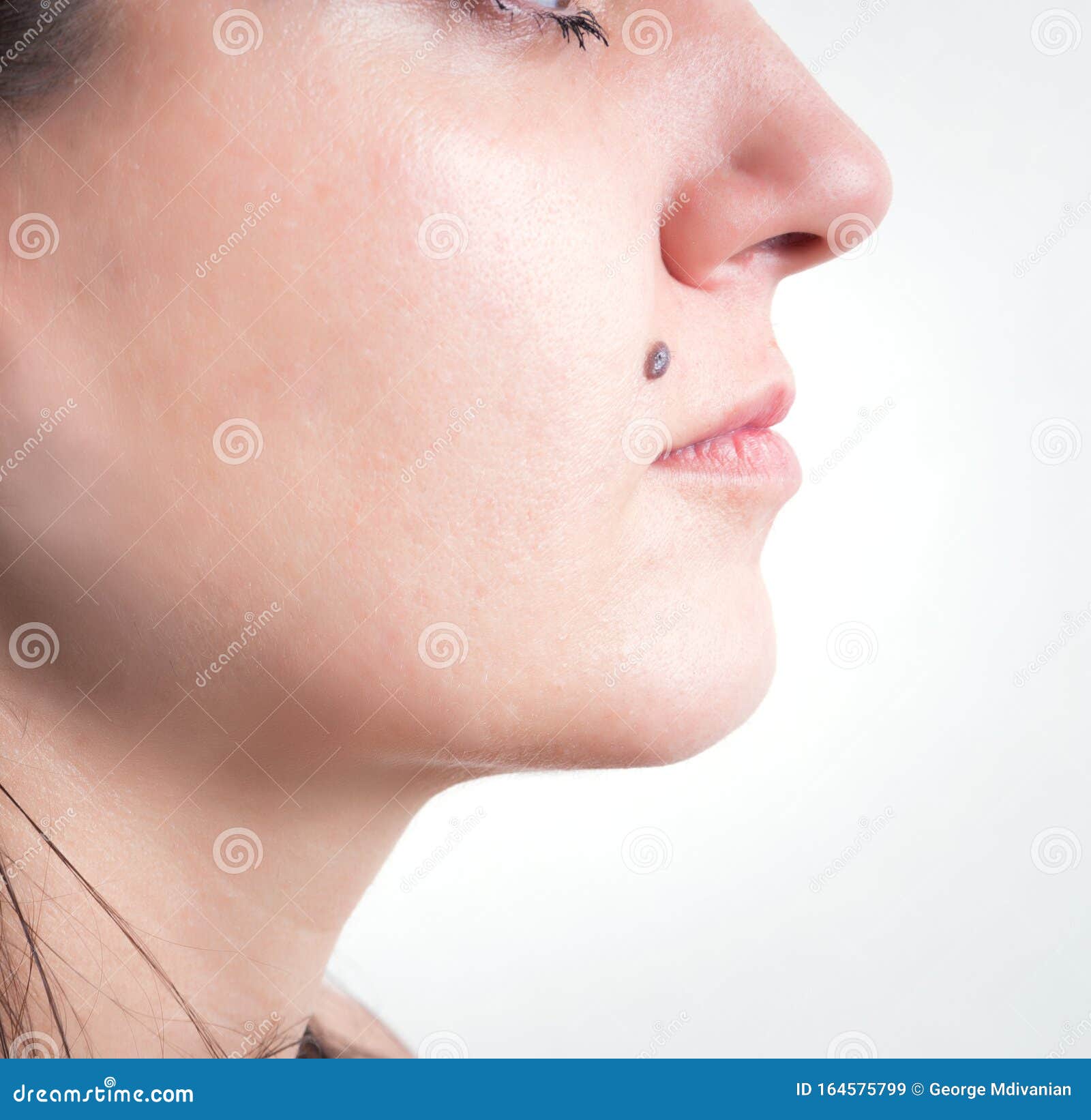 Mole on the face stock image. Image of cancerous, dermatologist - 164575799