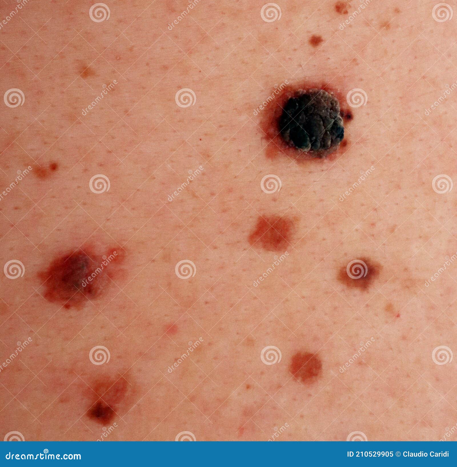 Freckles On Back Of Man Closeup On White Background. Pigmentation And ...