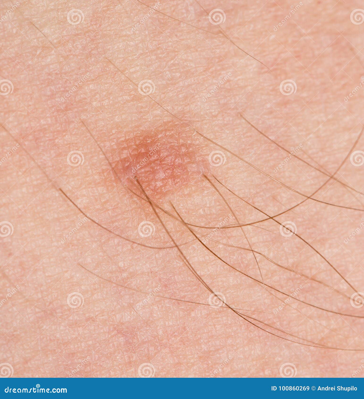 Mole on the Human Skin. Macro Stock Image - Image of spot, dermatology ...