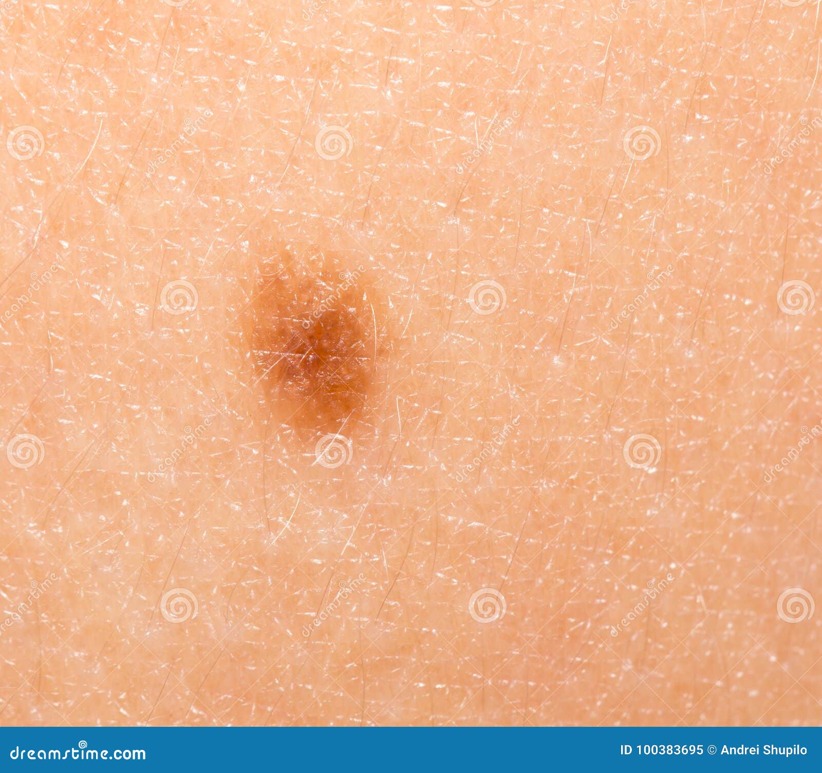 Mole on the human skin stock image. Image of people - 100383695
