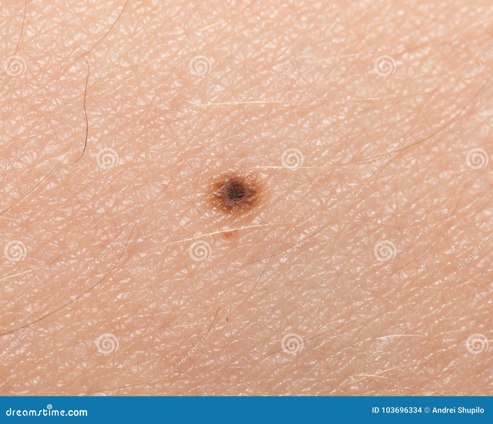 Mole on the human skin stock photo. Image of macro, nevus - 103696334