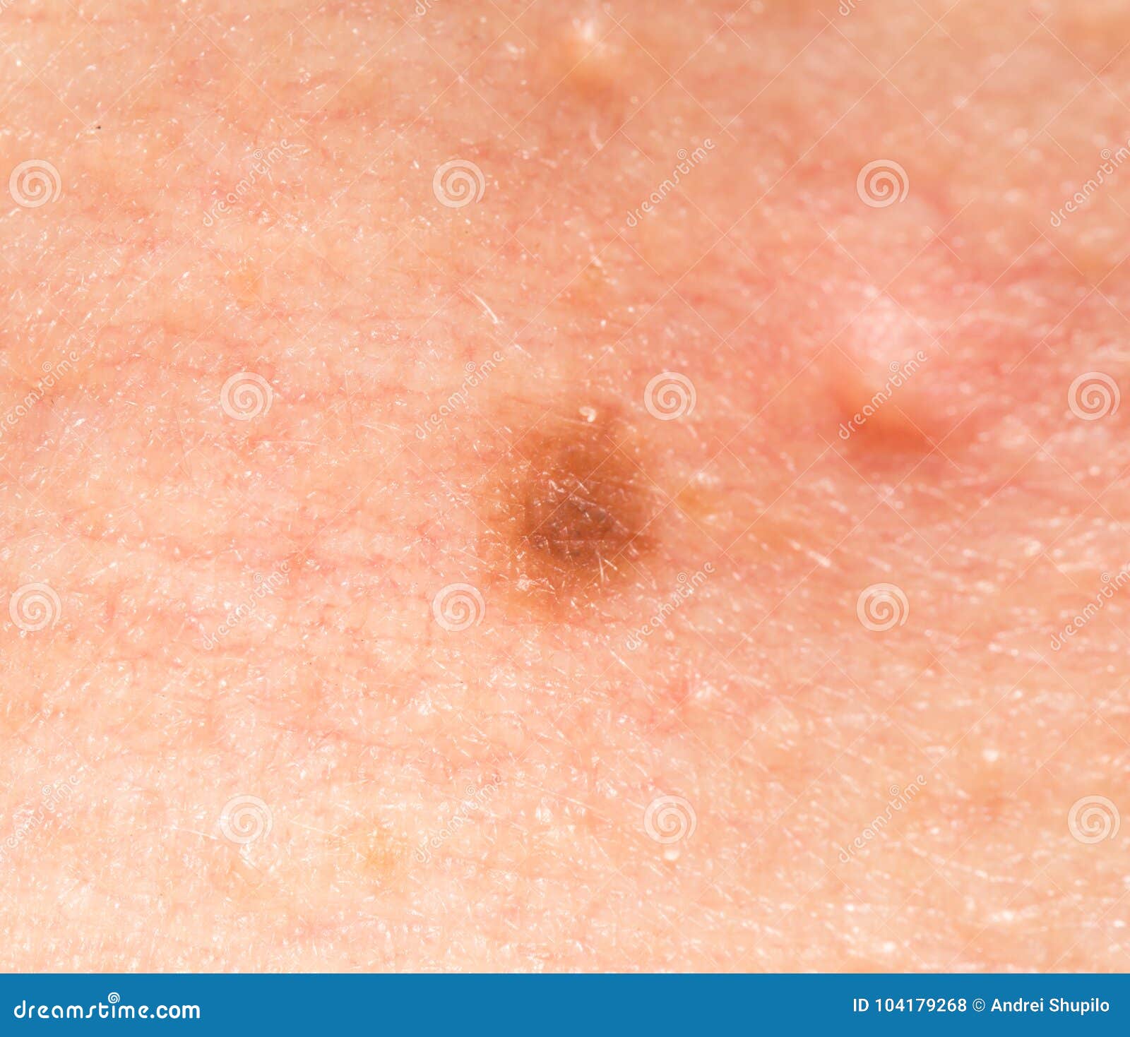 Mole on the human skin stock photo. Image of dermatology - 104179268