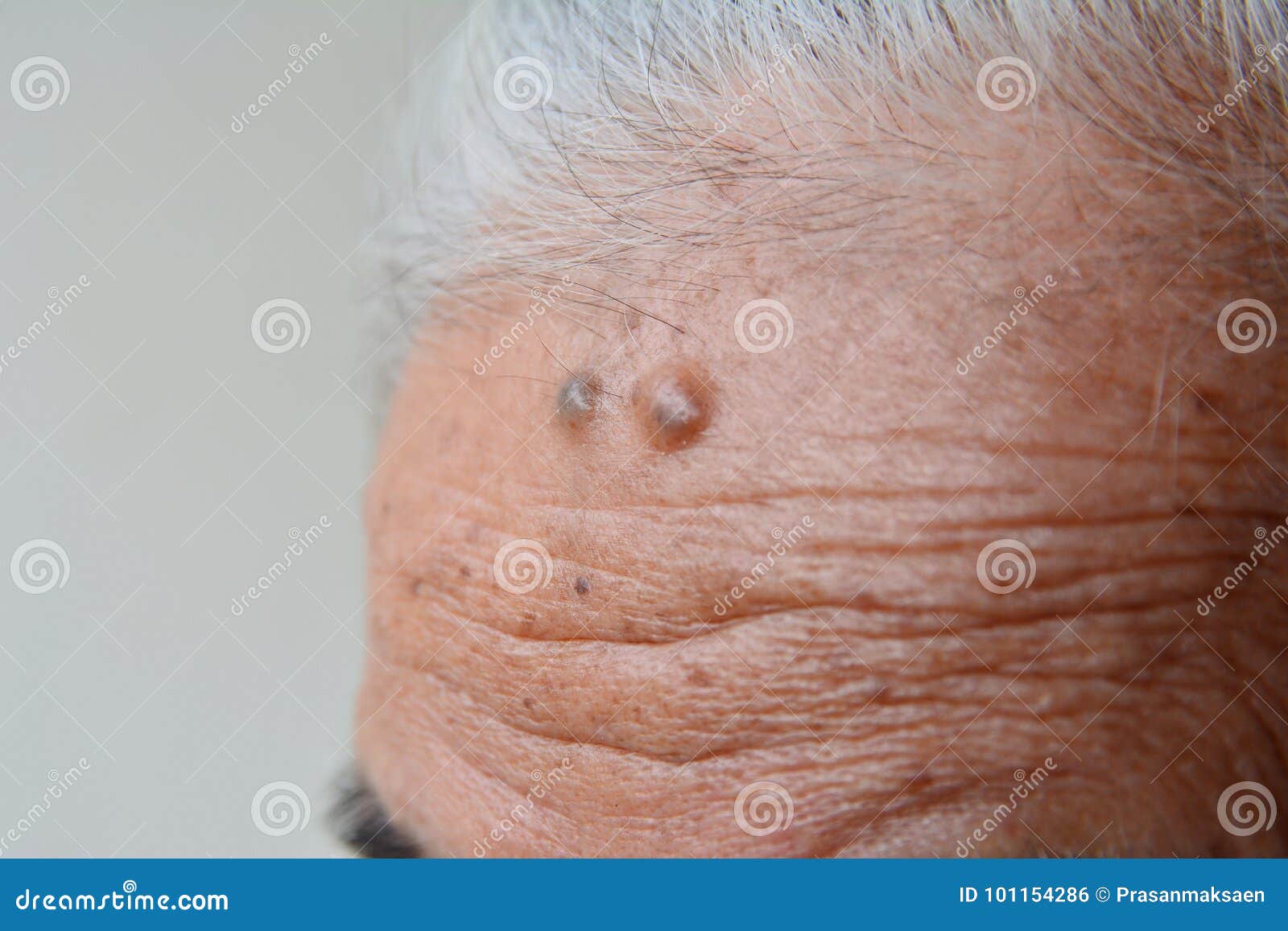 Mole On Face With Hair
