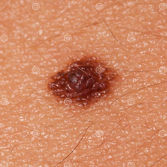 Mole - Muttermal stockfoto. Bild von makro, braun, verzweigung - 23916744