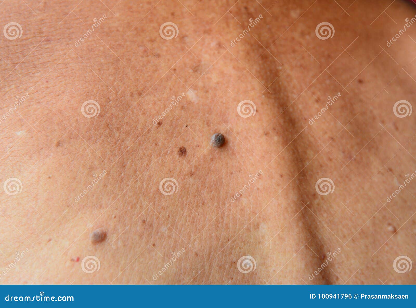 Mole stock photo. Image of black, healthcare, medicine - 100941796