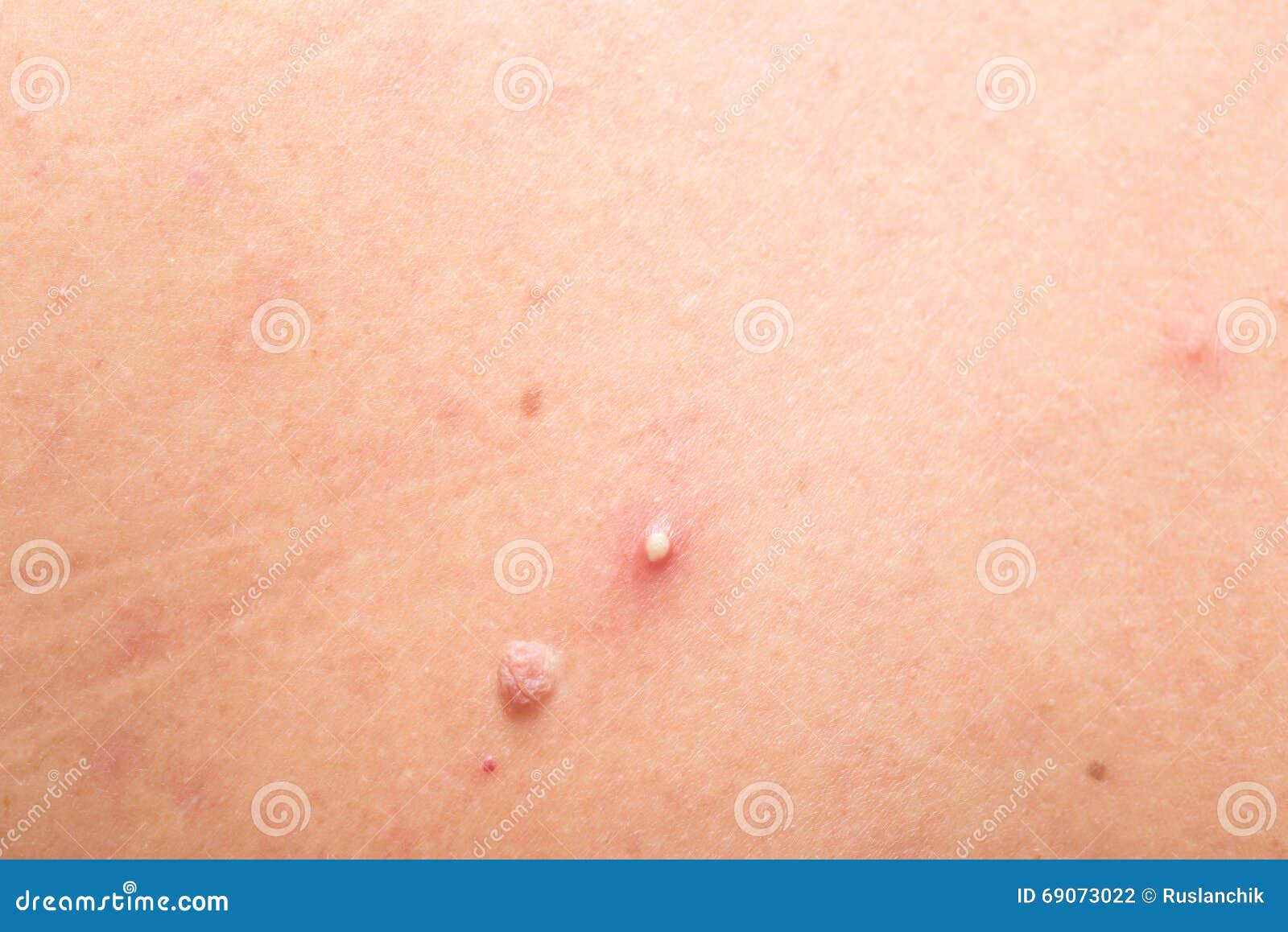 Mole and pimple stock photo. Image of problem, papule - 69073022