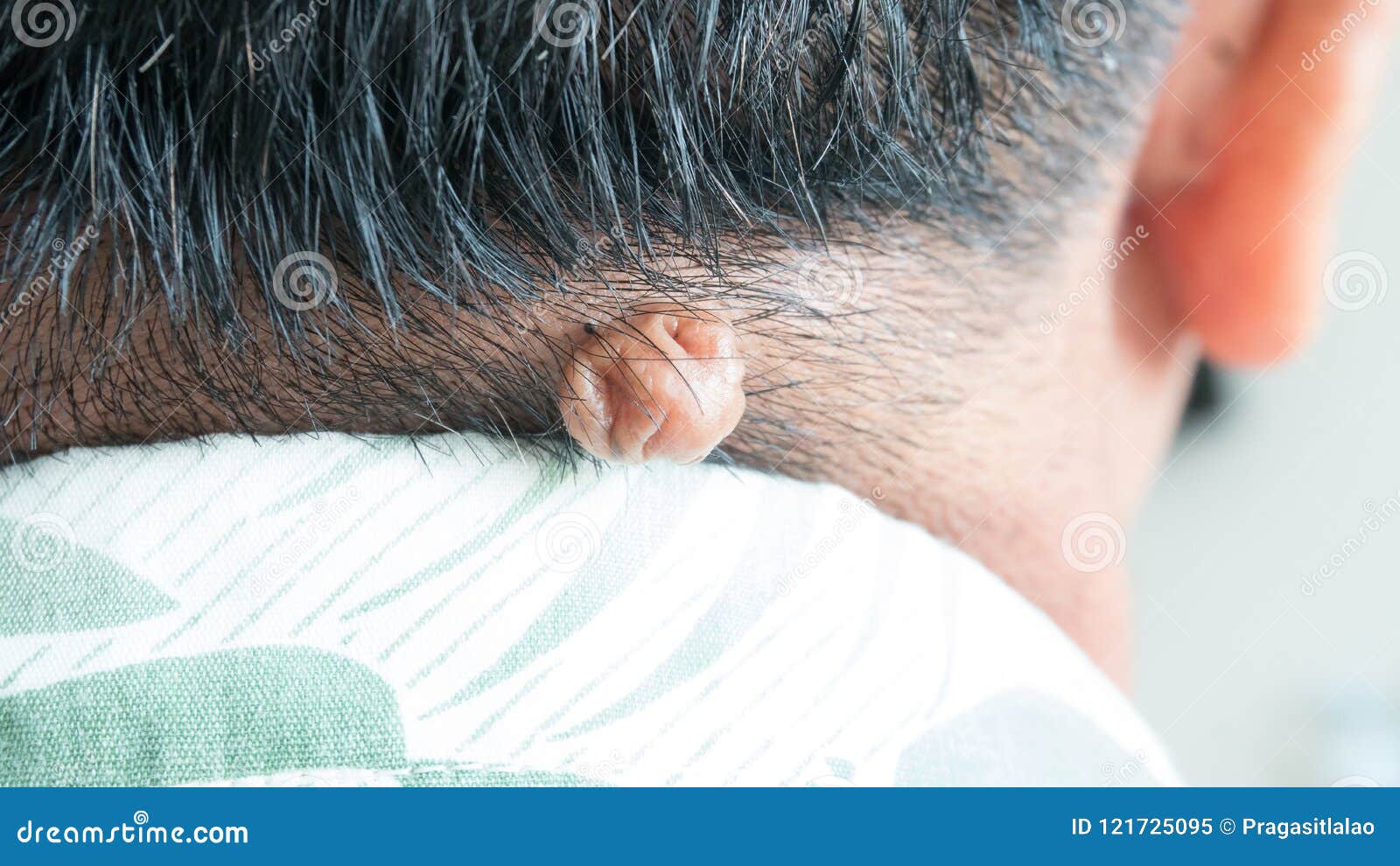 Mole on the Skin of the Body on Human Stock Image - Image of problem ...