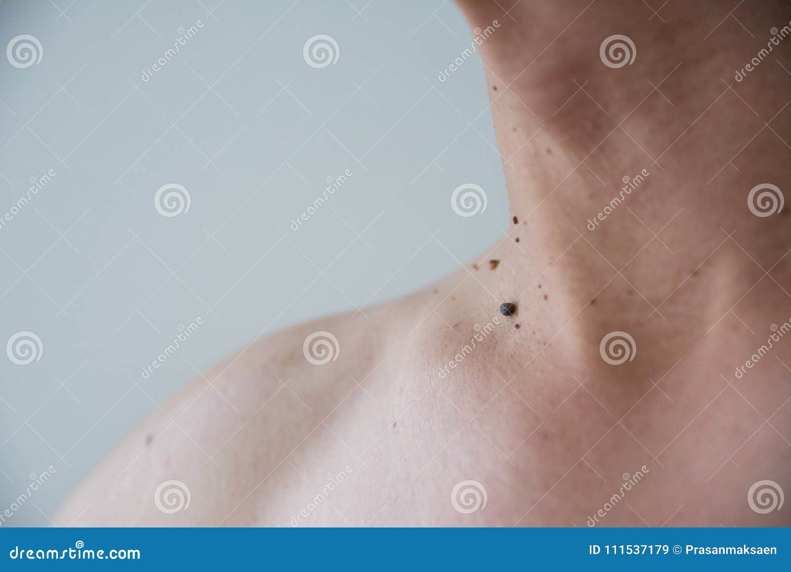 Mole or wart stock image. Image of adultmole, cancer - 111537179