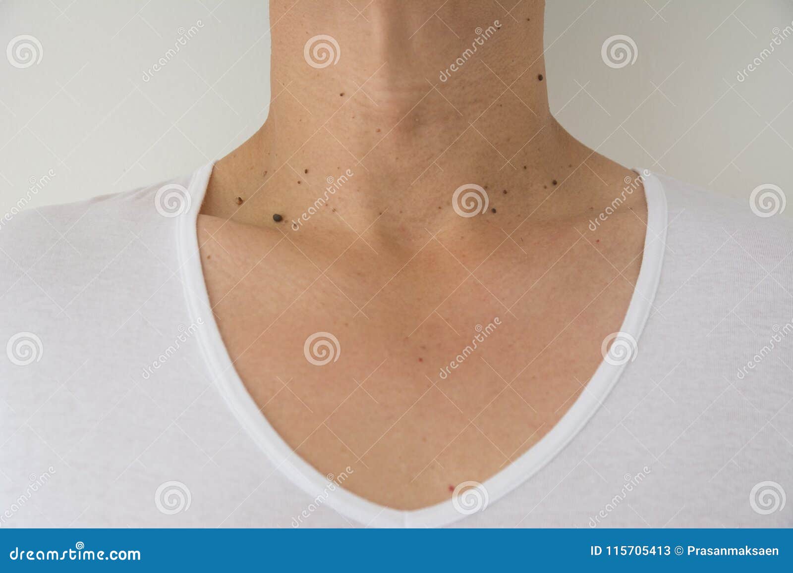 Mole or wart stock image. Image of examine, dermatologist - 115705413