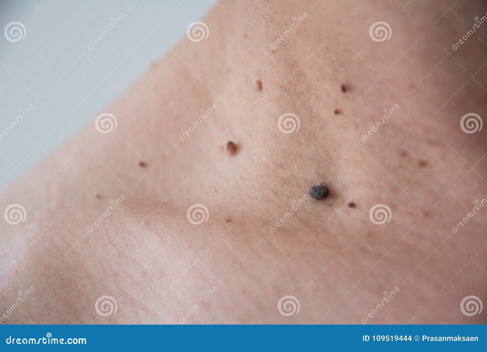Mole or wart stock photo. Image of keratosis, birthmark - 109519444