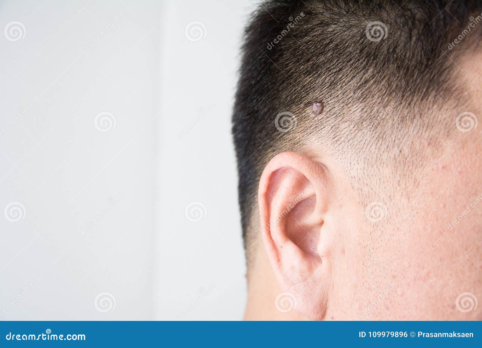 Mole or wart stock photo. Image of lump, consultation - 109979896