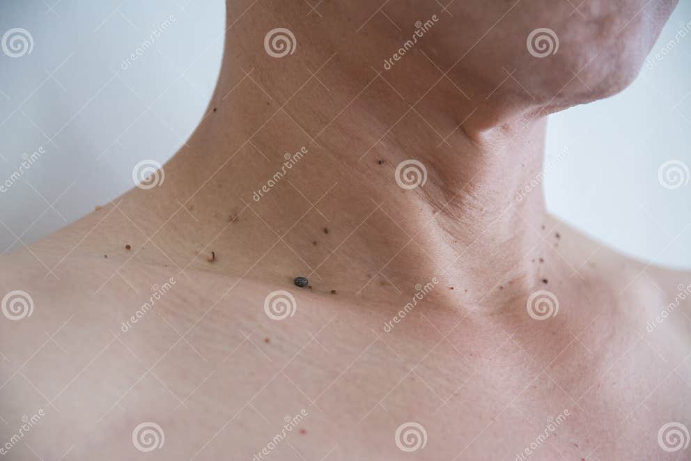 Mole or wart stock photo. Image of consultation, lump - 111619230