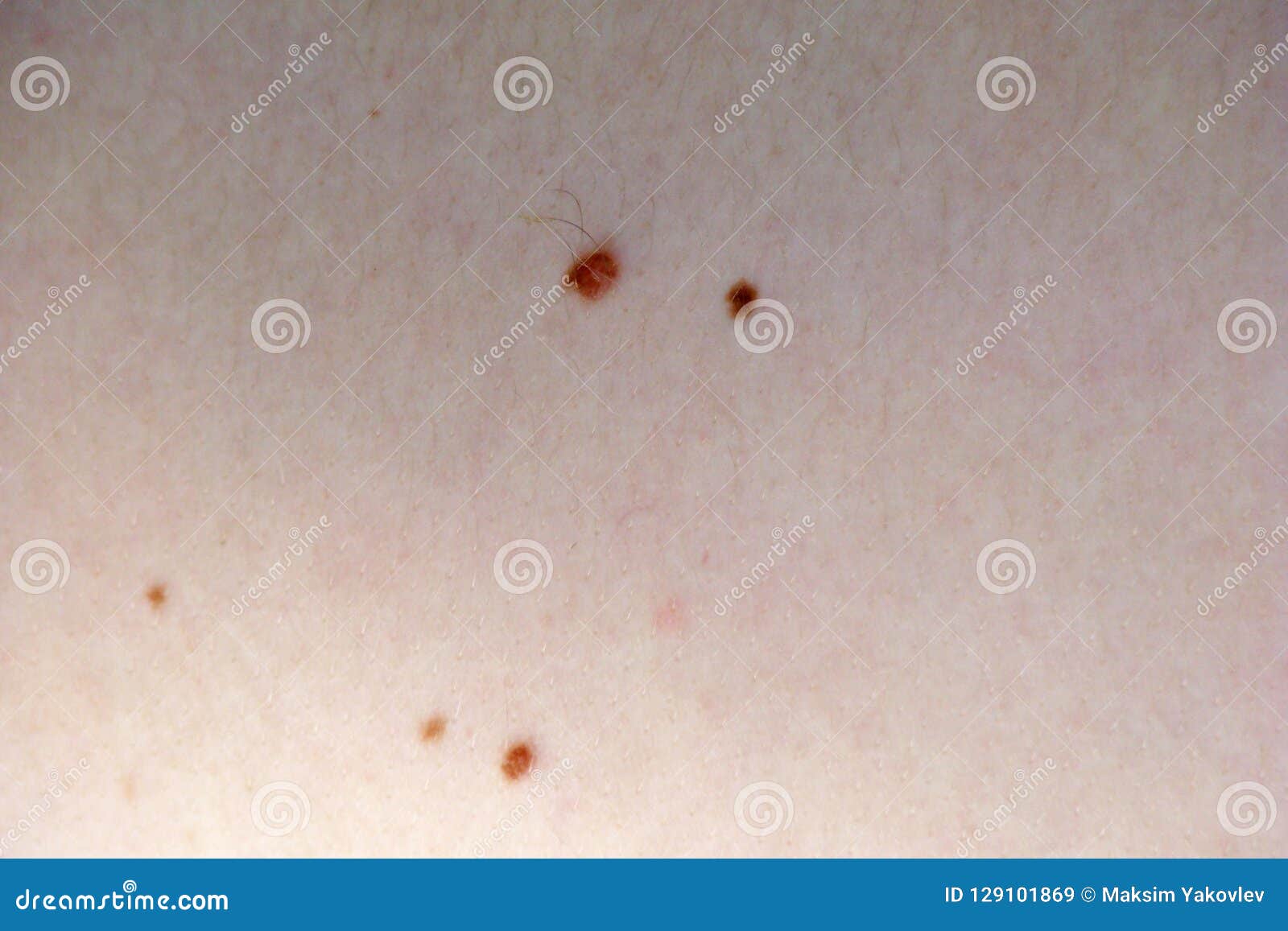 Moles on the back stock image. Image of excess, skin - 129101869
