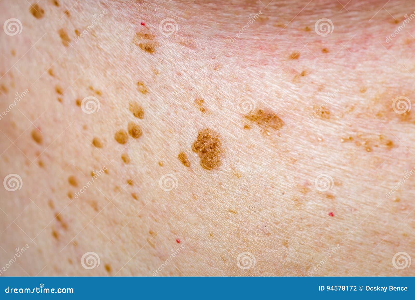 Molto neo su pelle umana fotografia stock. Immagine di cellula - 94578172