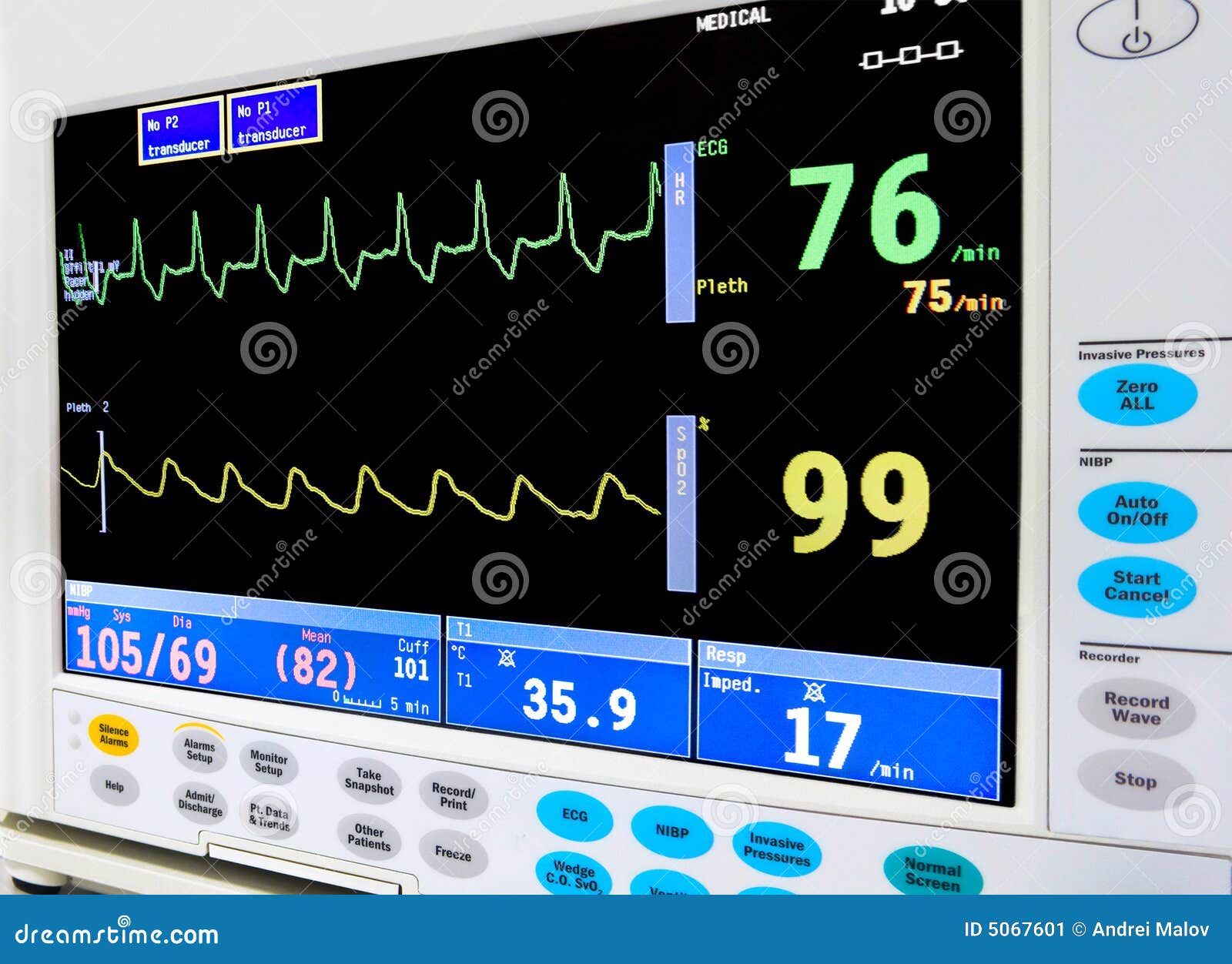 Icu Monitor Normal Range at Taylah North blog