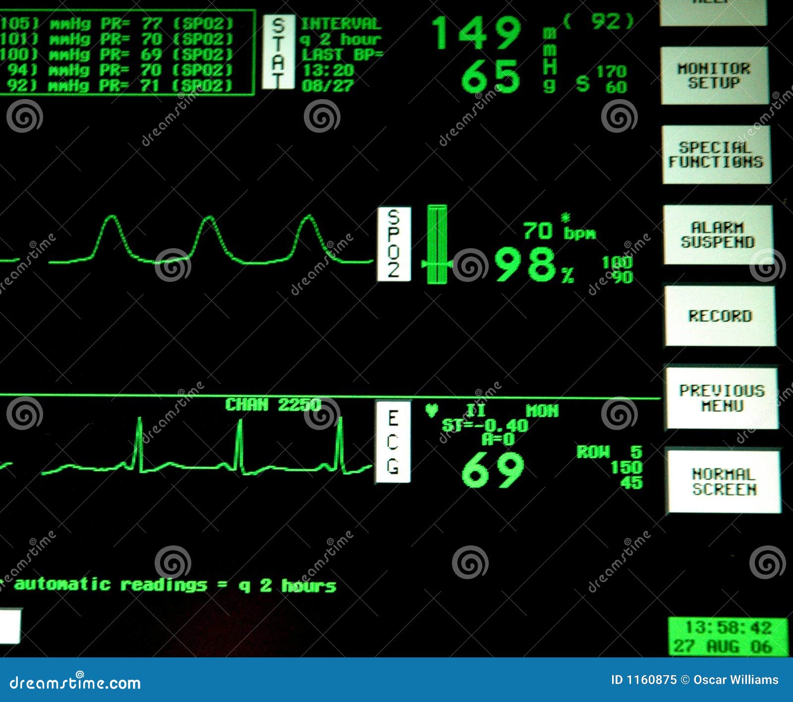 Monitor de corazón imagen de archivo. Imagen de medicina - 1160875
