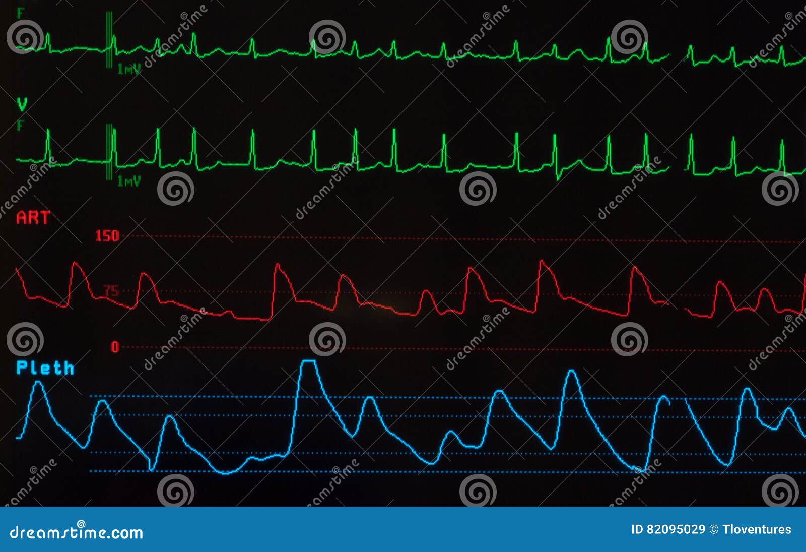 Monitor Met Atrial Fibrillatie Stock Afbeelding - Image of slagaderlijk ...