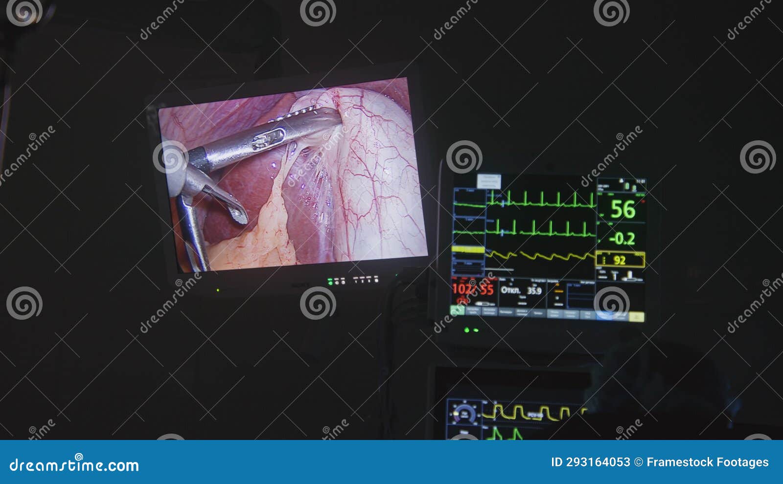 Monitor Screen with View from Laparoscopic Camera Stock Video - Video ...