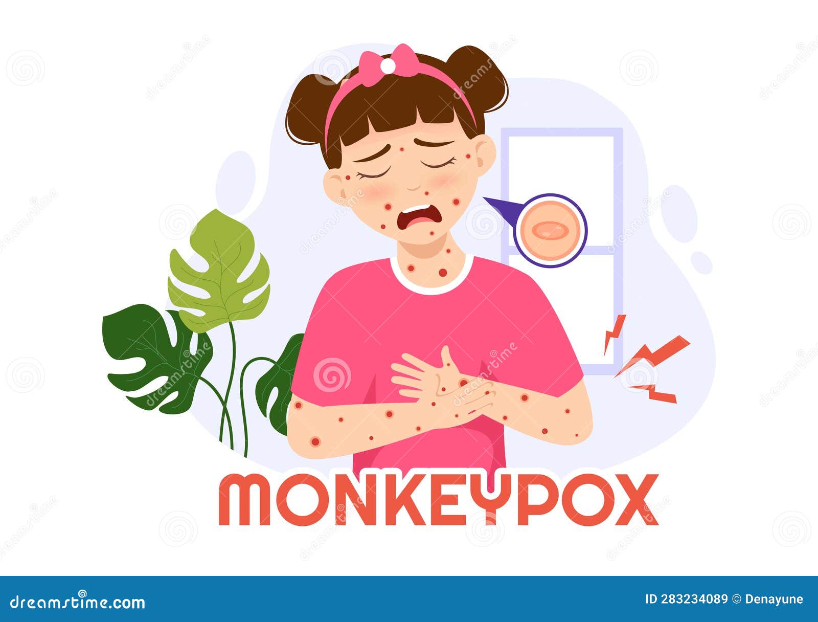 Symptoms Of The Monkeypox Virus. Monkey Pox Is Spreading. This Causes ...