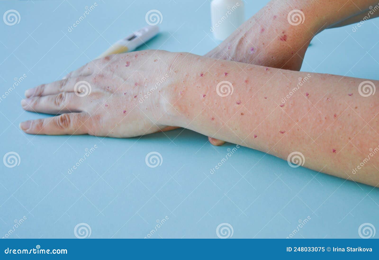 Monkey Pox Virus, a New World Problem of Modern Humanity. Close-up of ...