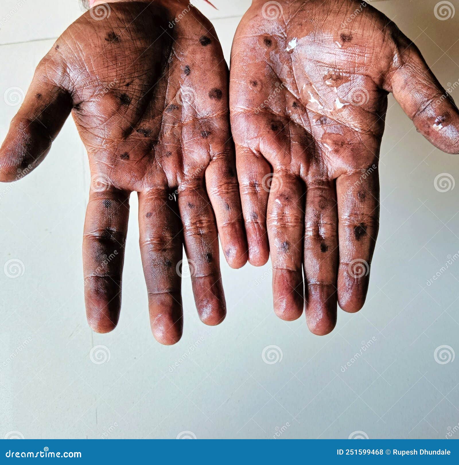 Monkey Pox Virus Transmitted in Human Body Stock Photo - Image of human ...