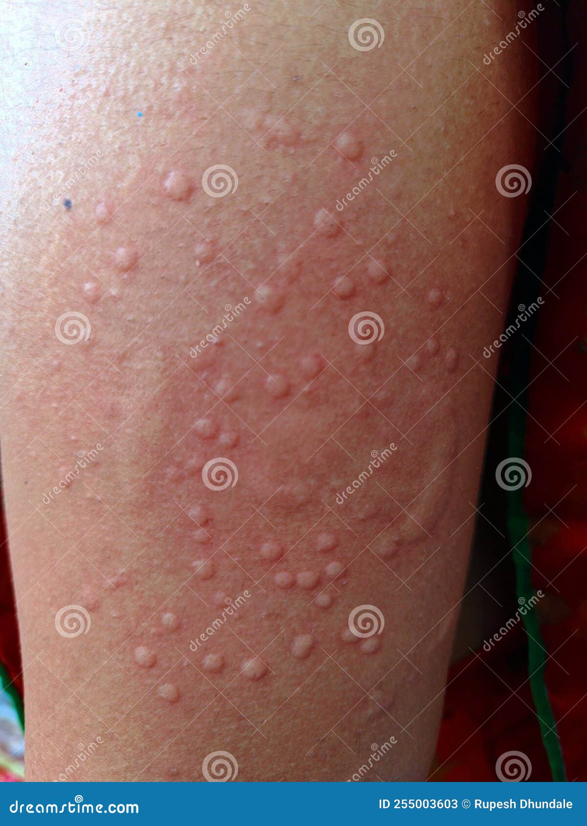 Monkey Pox Virus Transmitted in Human Body Stock Image - Image of derma ...