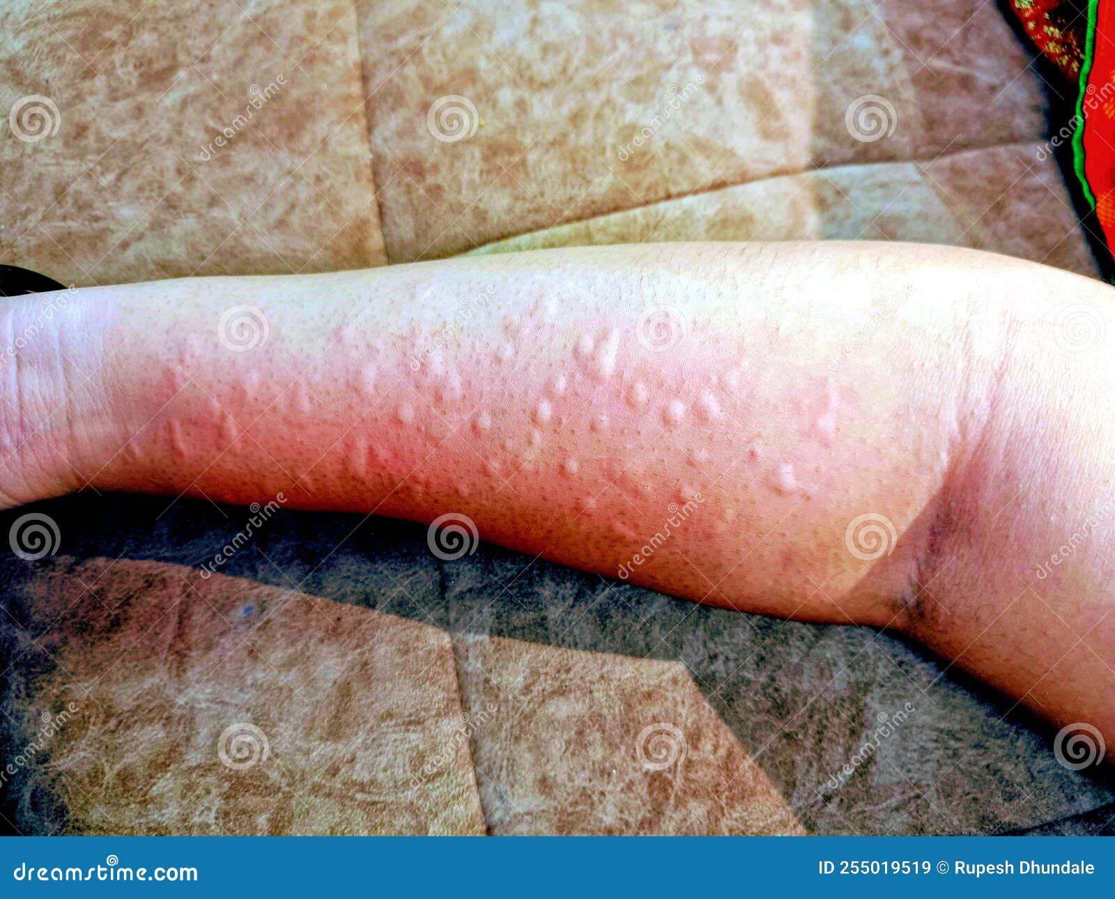 Monkey Pox Virus Transmitted in Human Body Stock Image - Image of derma ...